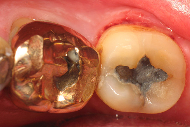Plaque Formation and Marginal Gingivitis Associated with Restorative ...