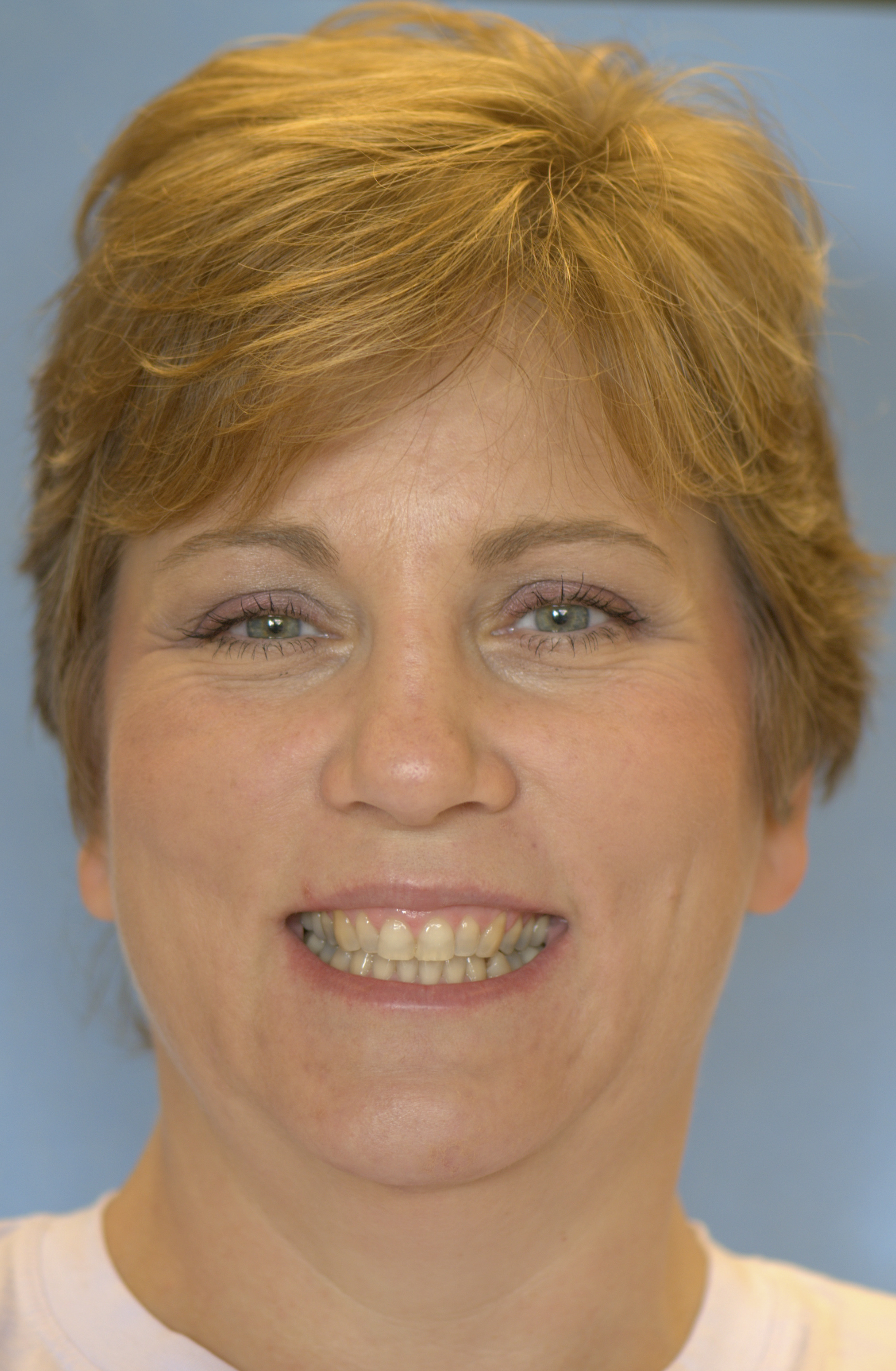 Treatment of a “Gummy Smile”: Understanding Etiology is Key to Success ...
