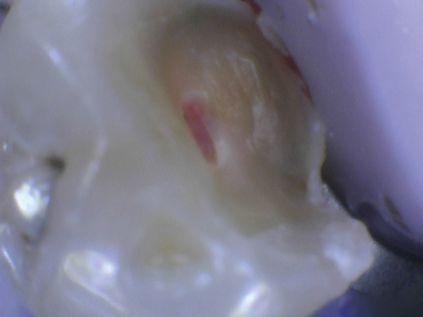 Vital Pulp Therapy: Managing Deep Caries in the Permanent Dentition ...