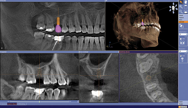 Sirona Imaging: All-Inclusive Implant Solution | Compendium