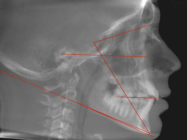 How a Discrepancy Between Centric Relation and Maximum Intercuspation ...