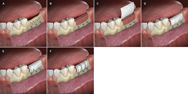Guided Bone Regeneration: Novel Use of Fixation Screws as an ...