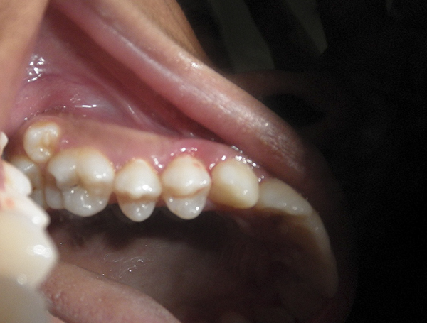 Bilateral Maxillary Paramolars in an Adolescent | Compendium