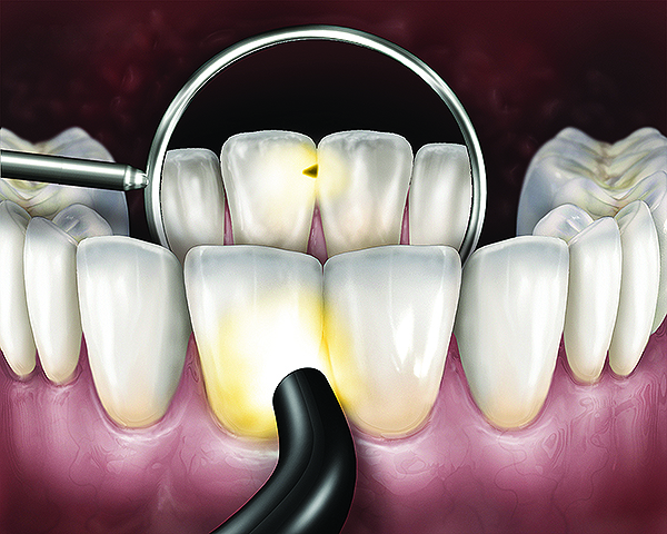 Using Fiber-Optic Transillumination as a Diagnostic Aid in Dental ...
