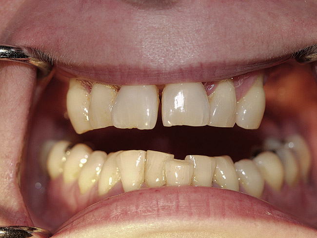 A Maxillary Fixed Bridge Supported by Dental Implants: Treatment ...