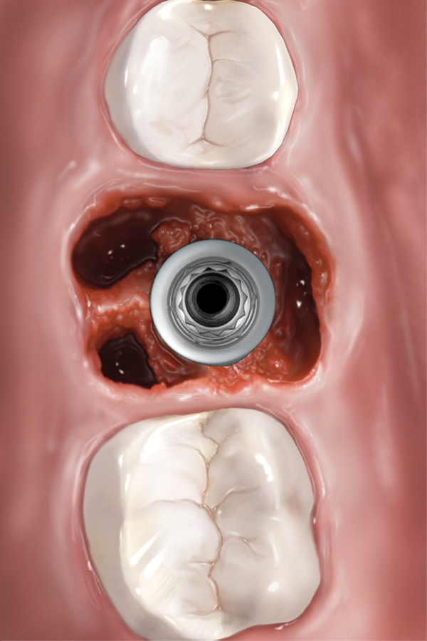 Immediate Placement of Dental Implants in Molar Extraction Sockets: An 11-Year Retrospective ...