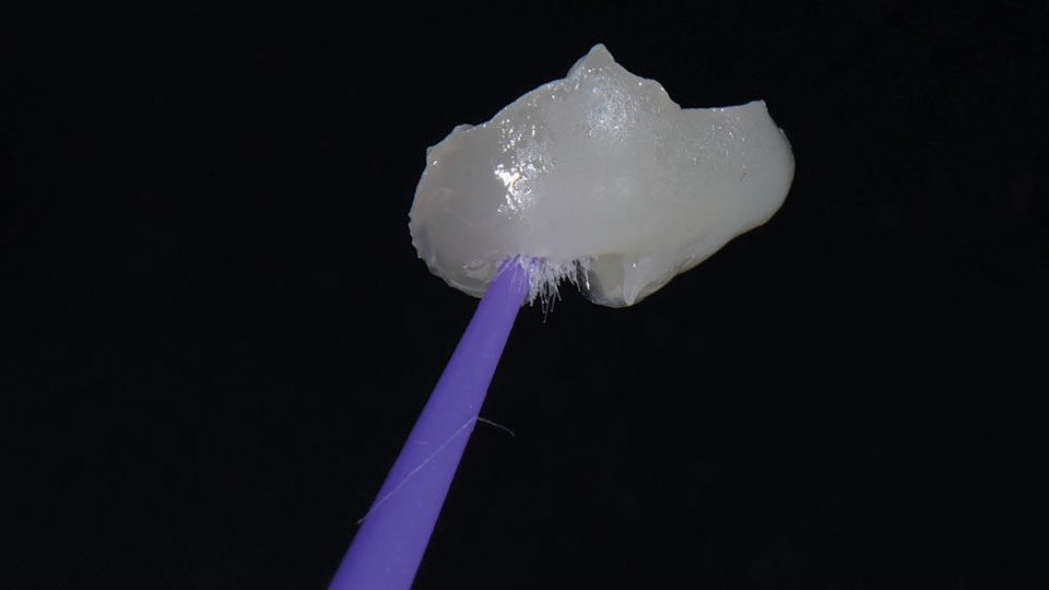 “Stamp” Technique to Recreate Accurate Occlusal Topography for Direct ...