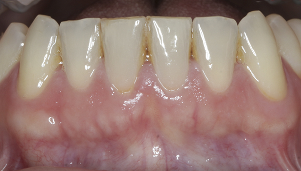 The Impact of Orthodontic Retainers on Gingival Recession: A Best ...