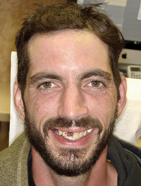 Immediate Implant Placement, Immediate Load With Same-Day Fully Digital ...