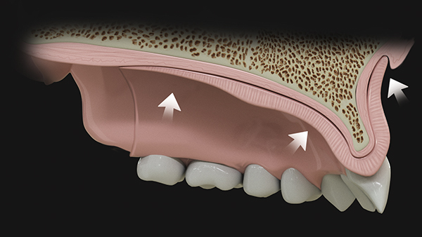Quantifying Flabby Ridge Tissue Displacement During Impression-Making ...