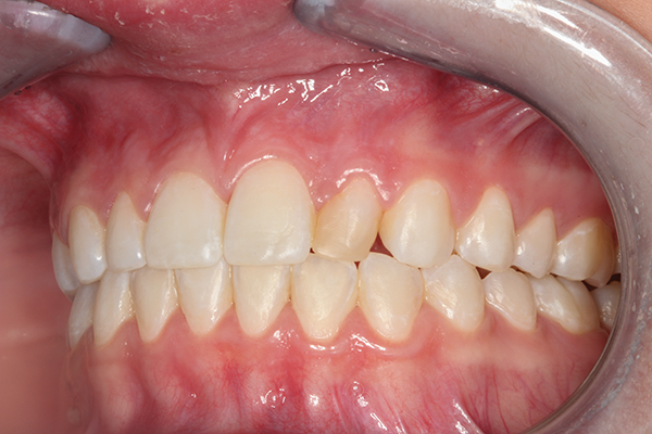 Chairside Anterior Build-up Simplified With Aura Ultra Universal ...