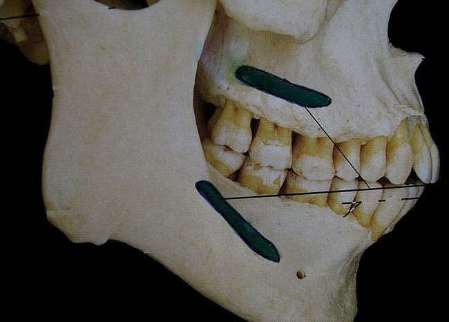 Buccinator Muscle Repositioning: A Case Report | Compendium