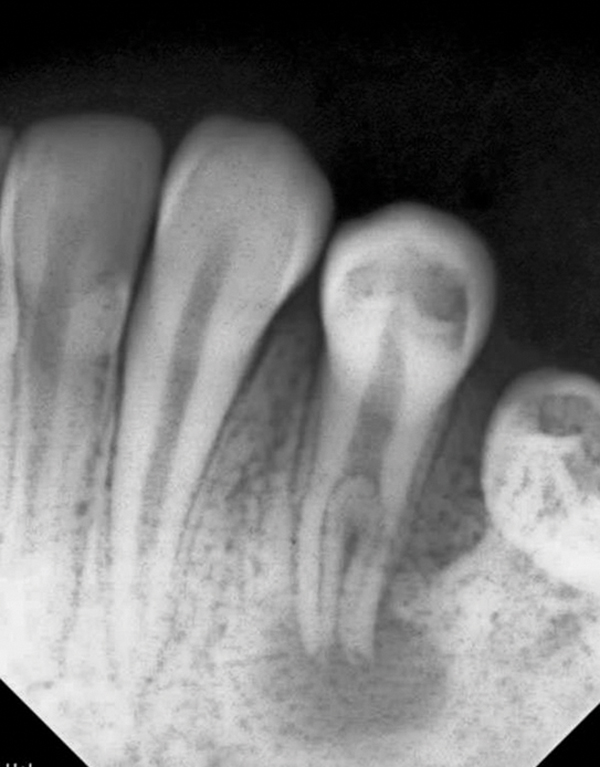 The Importance of Cone-Beam Computed Tomography in Endodontic Treatment ...