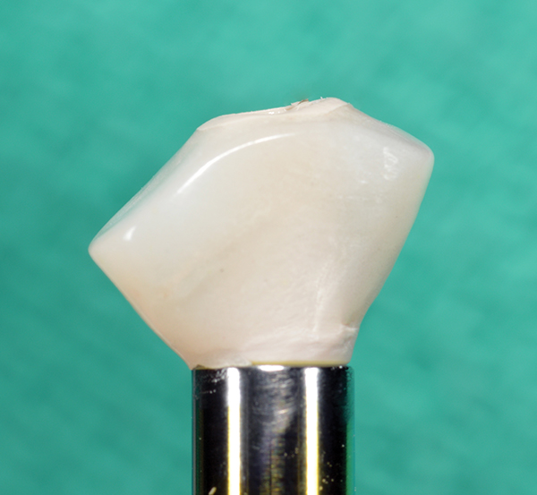 Cell Adhesion to Acrylic Custom Provisional Abutment Placed on an ...