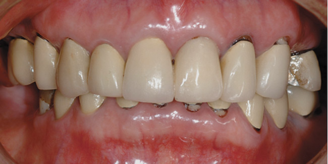 Complete Transition from Failing Restorations to Implant-Supported ...