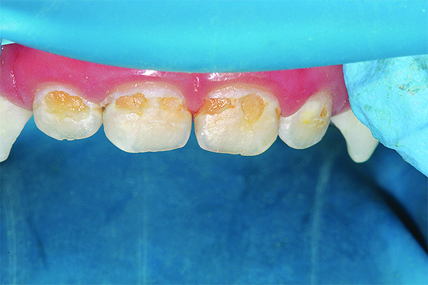 Zirconia Prefabricated Crowns for Pediatric Patients With Primary ...