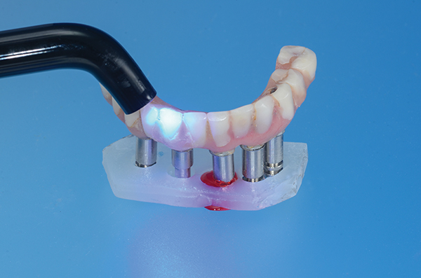 The Metal-Zirconia Implant Fixed Hybrid Full-Arch Prosthesis: An ...
