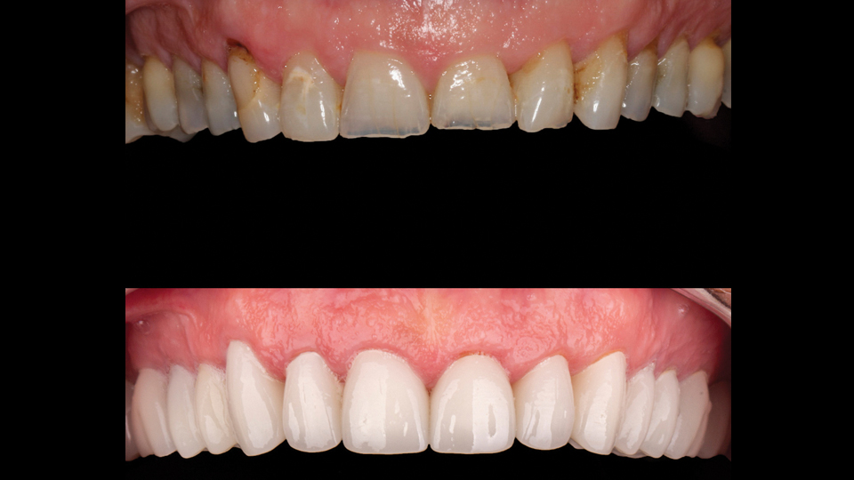 Single-Arch Reconstruction to Correct a Constricted Chewing Pattern ...