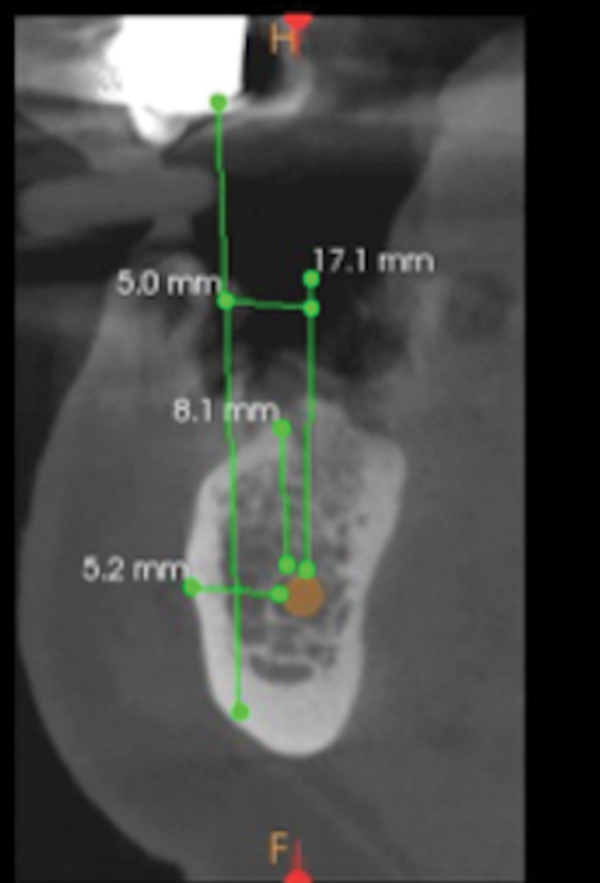 Implant Placement Lateral to the Inferior Alveolar Nerve: Selective ...