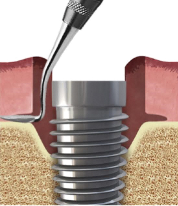 Circumferential Occlusal Access Procedure (COAP): Novel Minimally ...