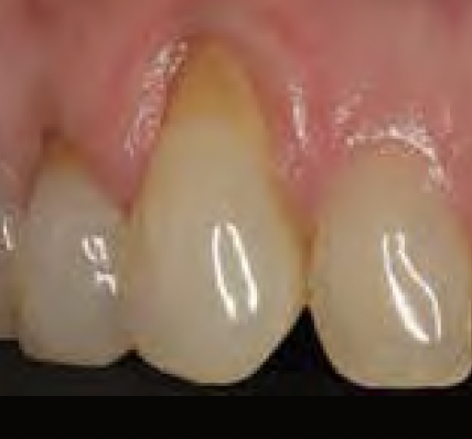 Treatment of Gingival Recession Using the Pinhole Surgical Technique ...