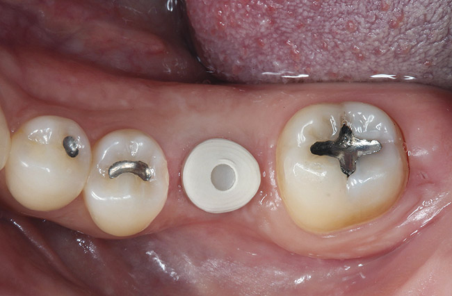 Glidewell’s Restorative-Driven Implant Solutions: Simple, Convenient ...