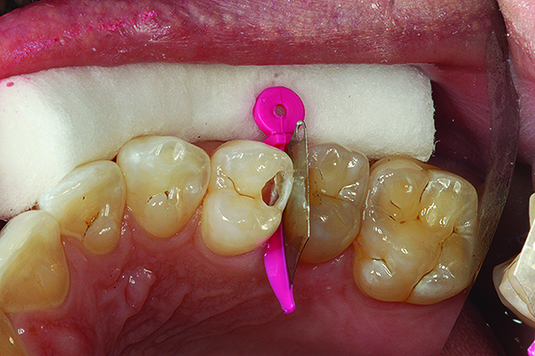 Incipient Decay Treatment: Tunneling to Success | Compendium