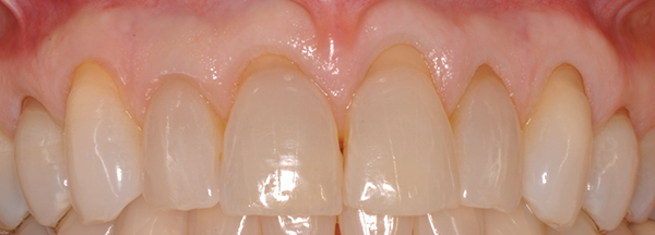 Minimally Invasive Coronally Advanced Flap Techniques for Correction of ...