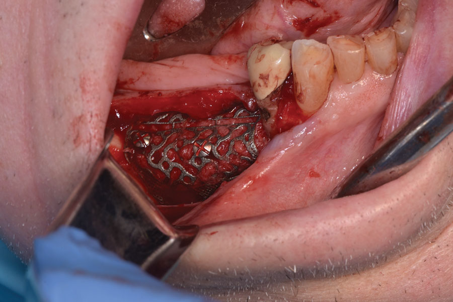 Use of a Cellular Bone Matrix and Custom Titanium Mesh Scaffold for ...