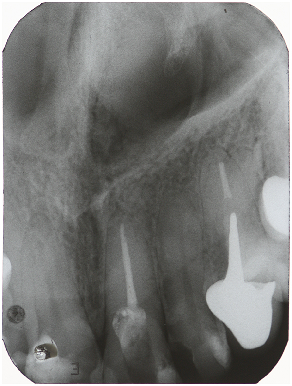 Transurgical Restoration With Glass-Ionomer Cement As an Option for ...