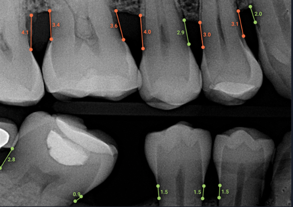 Improving Periodontal Disease Management With Artificial Intelligence ...