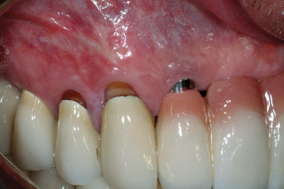 Modified Tunnel Technique and Double-Layer Acellular Dermal Matrix to ...