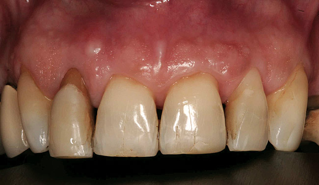 Soft- and Hard-Tissue Augmentation by Orthodontic Treatment in the ...