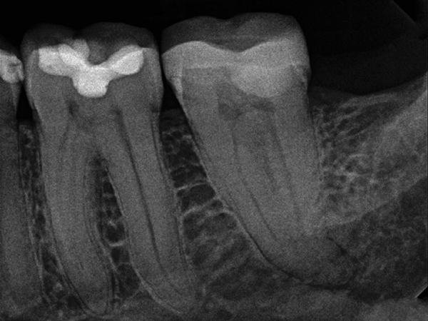 Single-Visit Endodontic Procedure for a C-Shaped Molar | Compendium
