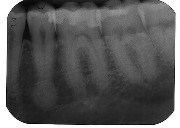 Cementoblastoma Mimicking Pathology of Endodontic Origin: A Case Report ...