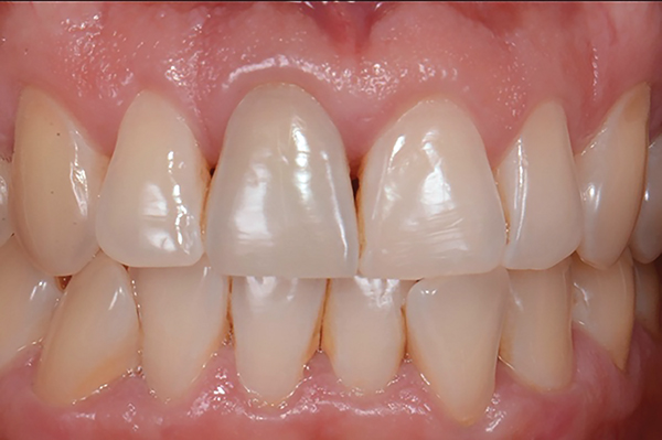 A Modified Socket-Shield Technique: Simplifying the Root Sectioning ...