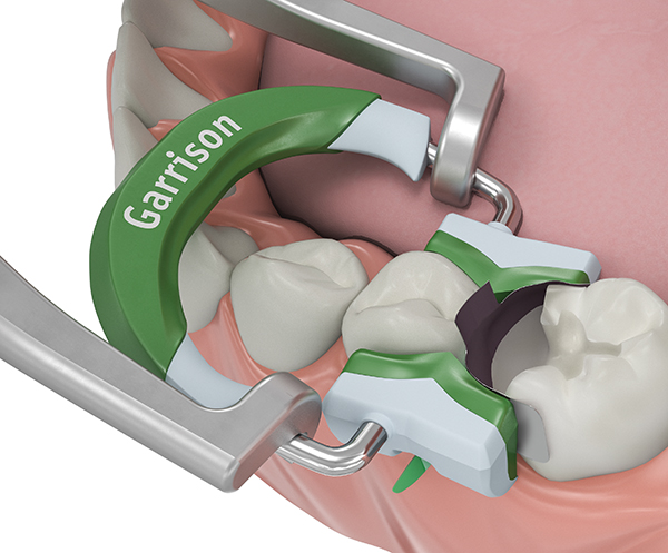 New Sectional Matrix System Simplifies Posterior Direct Composite ...