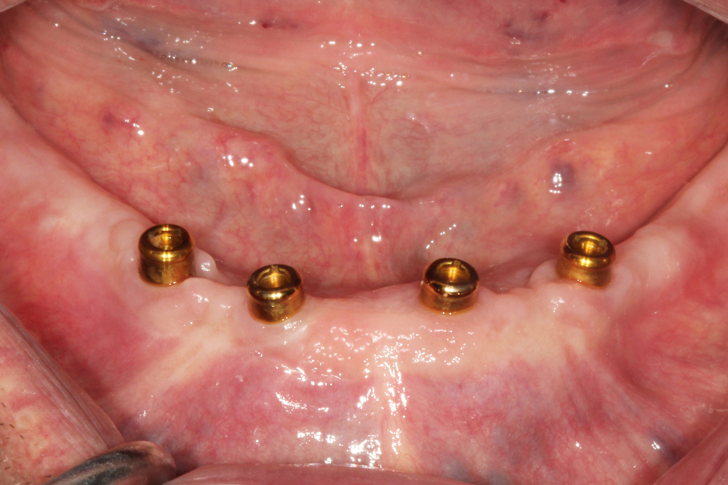 Managing Angulation Challenges With Implant Overdentures | Compendium