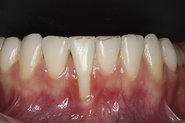 Modified Double-Papillae Flap Technique With Subepithelial Connective ...