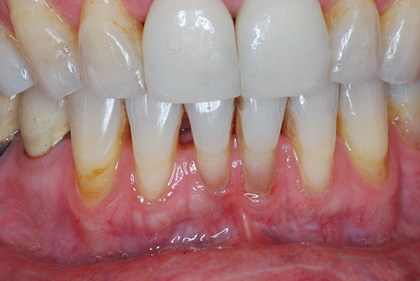Incidental Finding of a Suspected Horizontal Root Fracture During ...