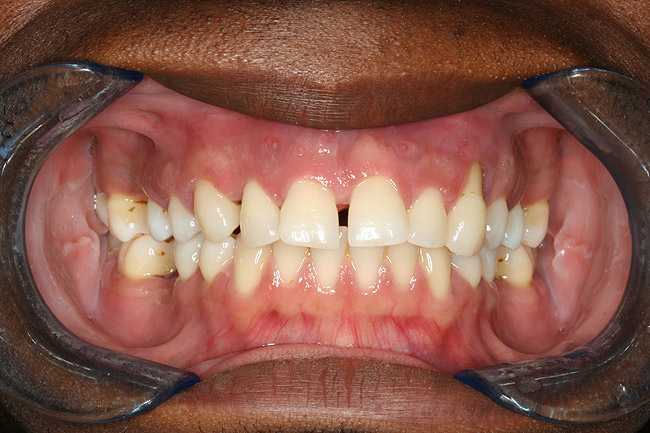 A Clinical and Histological Comparison of Two Different Bone ...