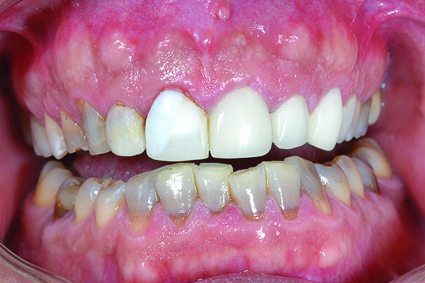 Use of Zirconia-Reinforced Lithium Silicate (ZLS) to Restore Stained ...