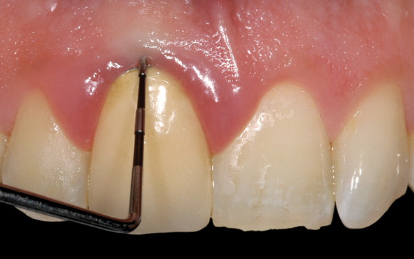 A Review of the Positive Influence of Crown Contours on Soft-Tissue ...