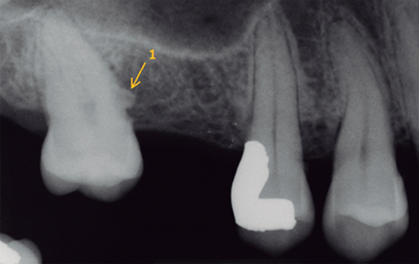 Cervical Enamel Projection