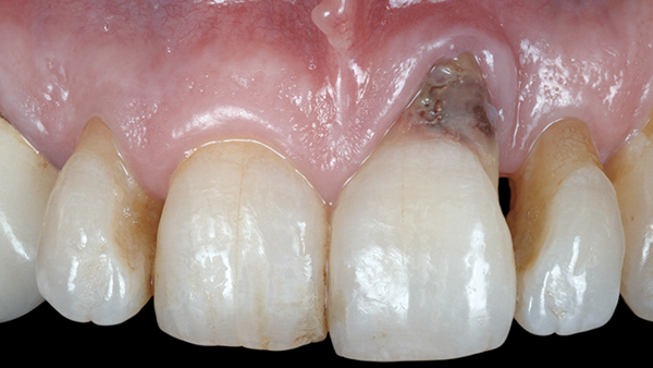 Use of Tuberosity Tissue Block for Tunneling Reconstruction of Class ...