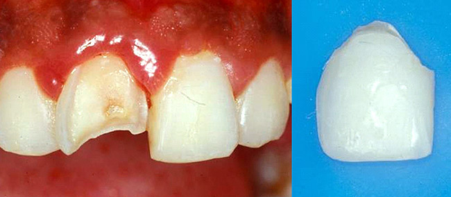 Uncommon Crown-Root Fracture Treated with Adhesive Tooth Fragment ...