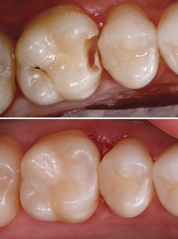 Bulk EZ PLUS™: Dual-Cure Bulk-Fill Composite Ideal for Direct ...