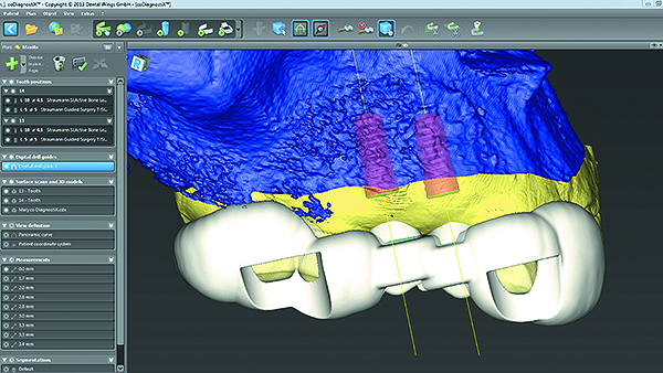 Using Dental GPS to Navigate Implant Placement | Compendium