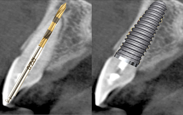 Surgical and Prosthetic Considerations With Immediate Implant Placement ...