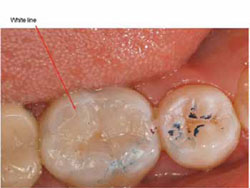 Comparative Properties of Low-Shrinkage Composite Resins | Compendium